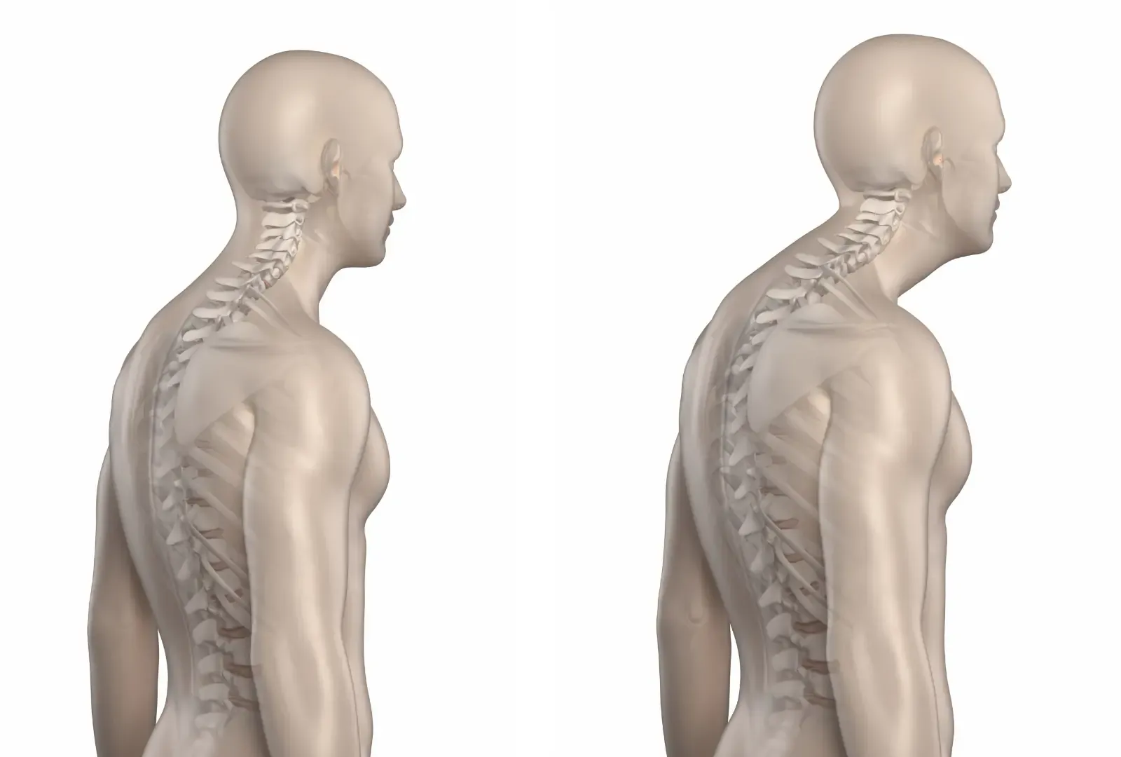 kyphosis surgery risks